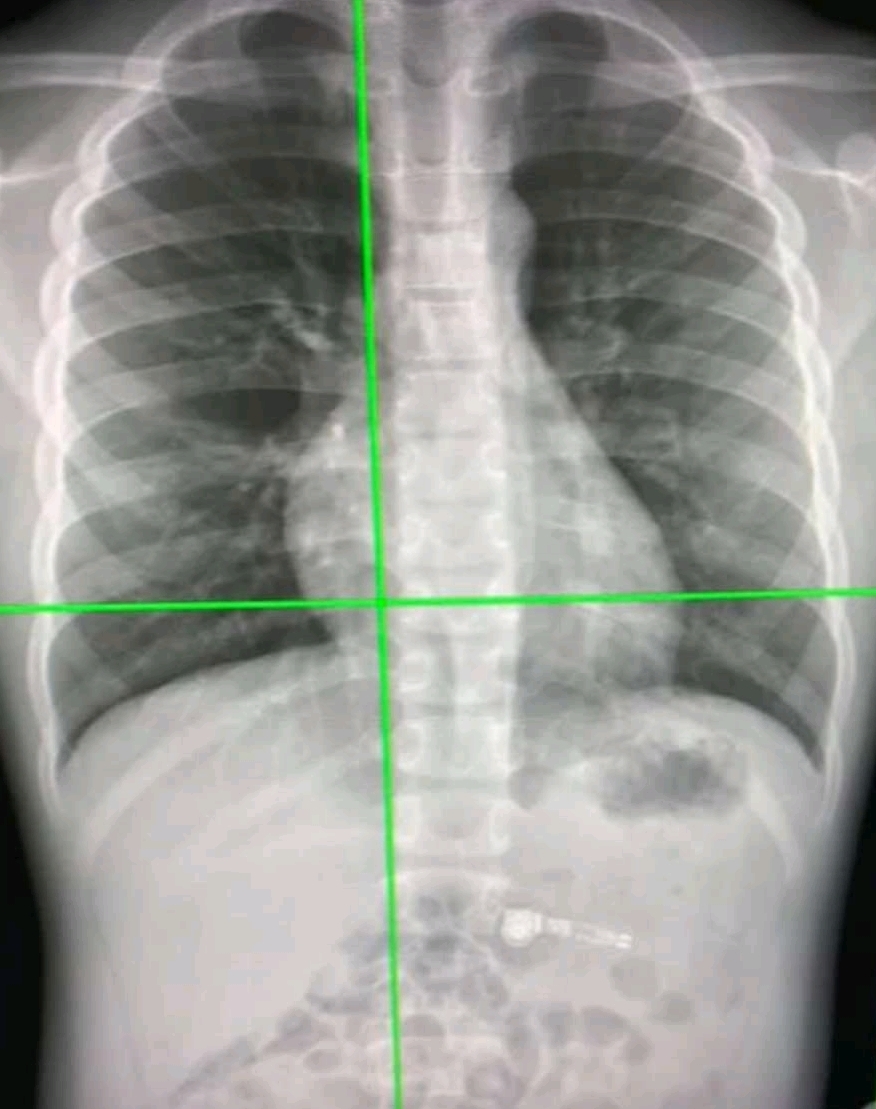 AI-powered X-rays Can Tell True Age By Looking At Chest | Glamsham