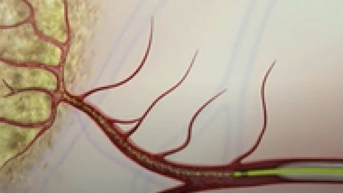 New Minimally Invasive Therapy Shows Promise For Liver Cancer Patients ...