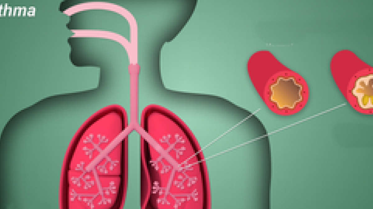 Food Allergy In Infancy May Cause Asthma & Poor Lung Function Later ...