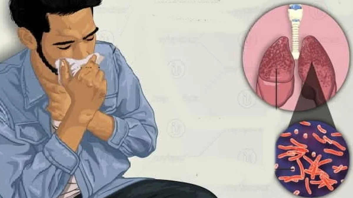 TB Diagnosis Must Go Beyond Persistent Cough: Lancet Study | Glamsham