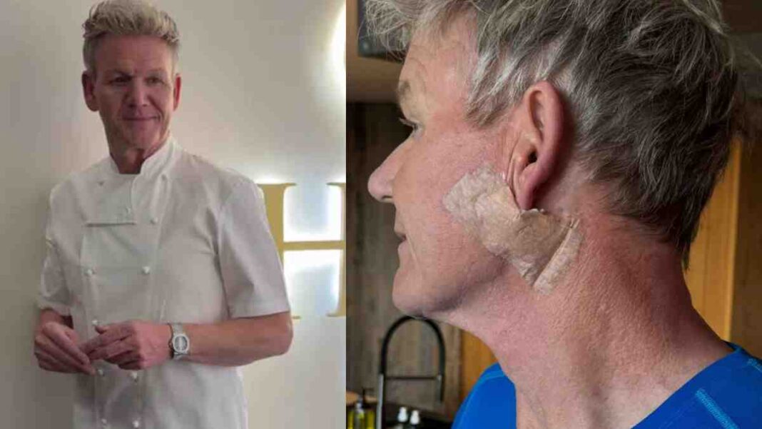 Gordon Ramsay Reveals Skin Cancer Surgery, Urges Fans To Wear Sunscreen ...
